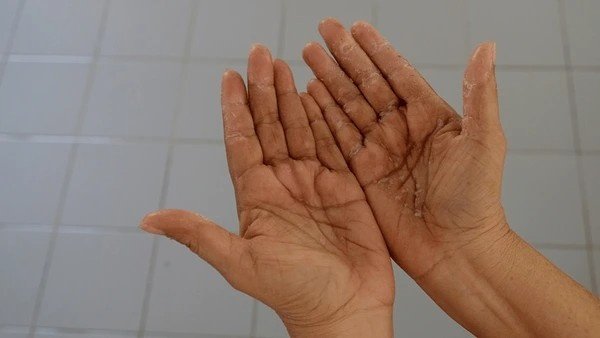 কেমোথেরাপি (Chemotherapy) চলাকালীন ত্বকের যত্ন: র‍্যাশ (Rash) এড়ানোর ...